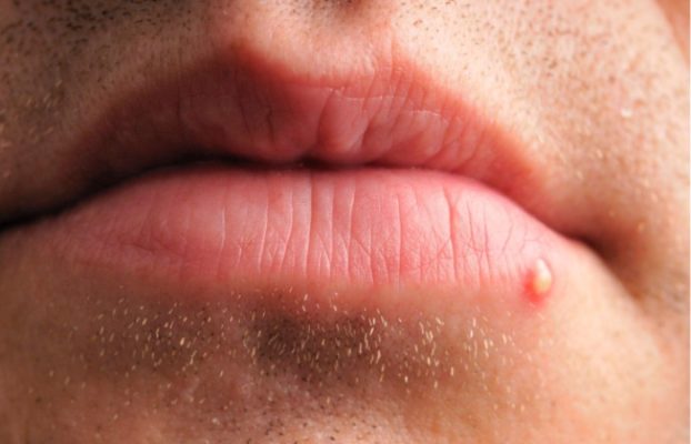 Pimple on Lip – Explanation, Causes, Treatment, And More - 2022