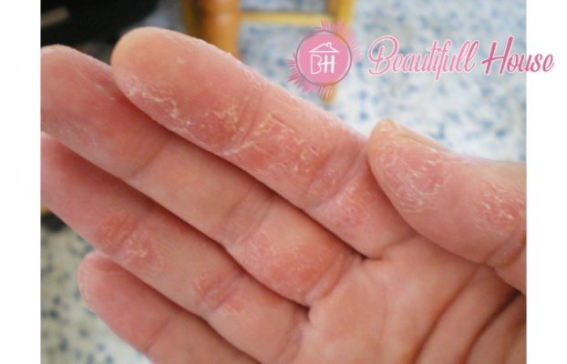 Dry Hands – Definition, Causes, Types and Treatment, And More